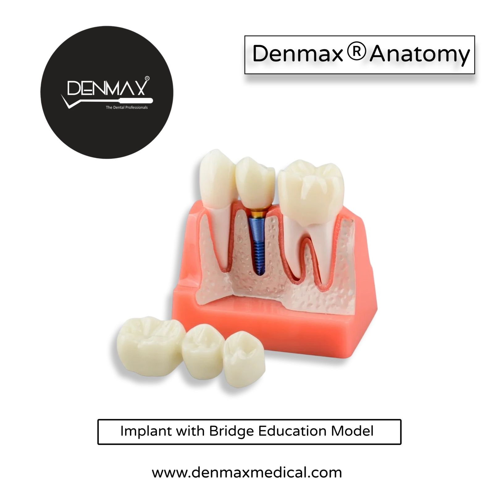 High-Quality Dental Implant with Bridges Model
